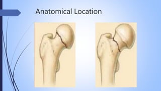 Intra capsular neck of femur fractures | PPTX