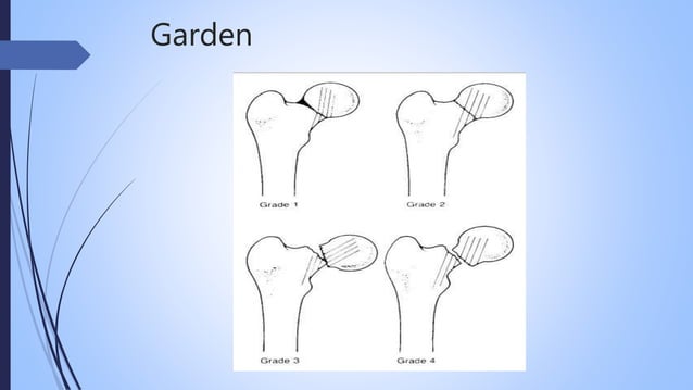 Intra capsular neck of femur fractures | PPTX