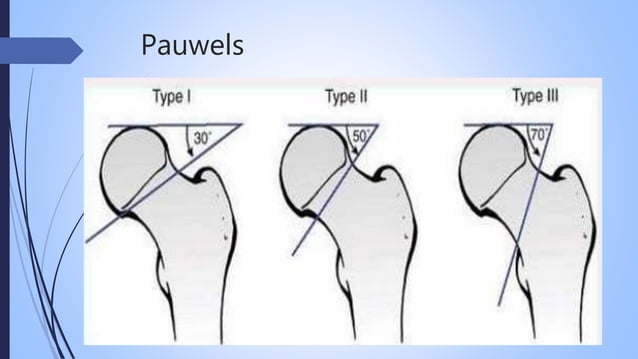 Intra capsular neck of femur fractures | PPTX