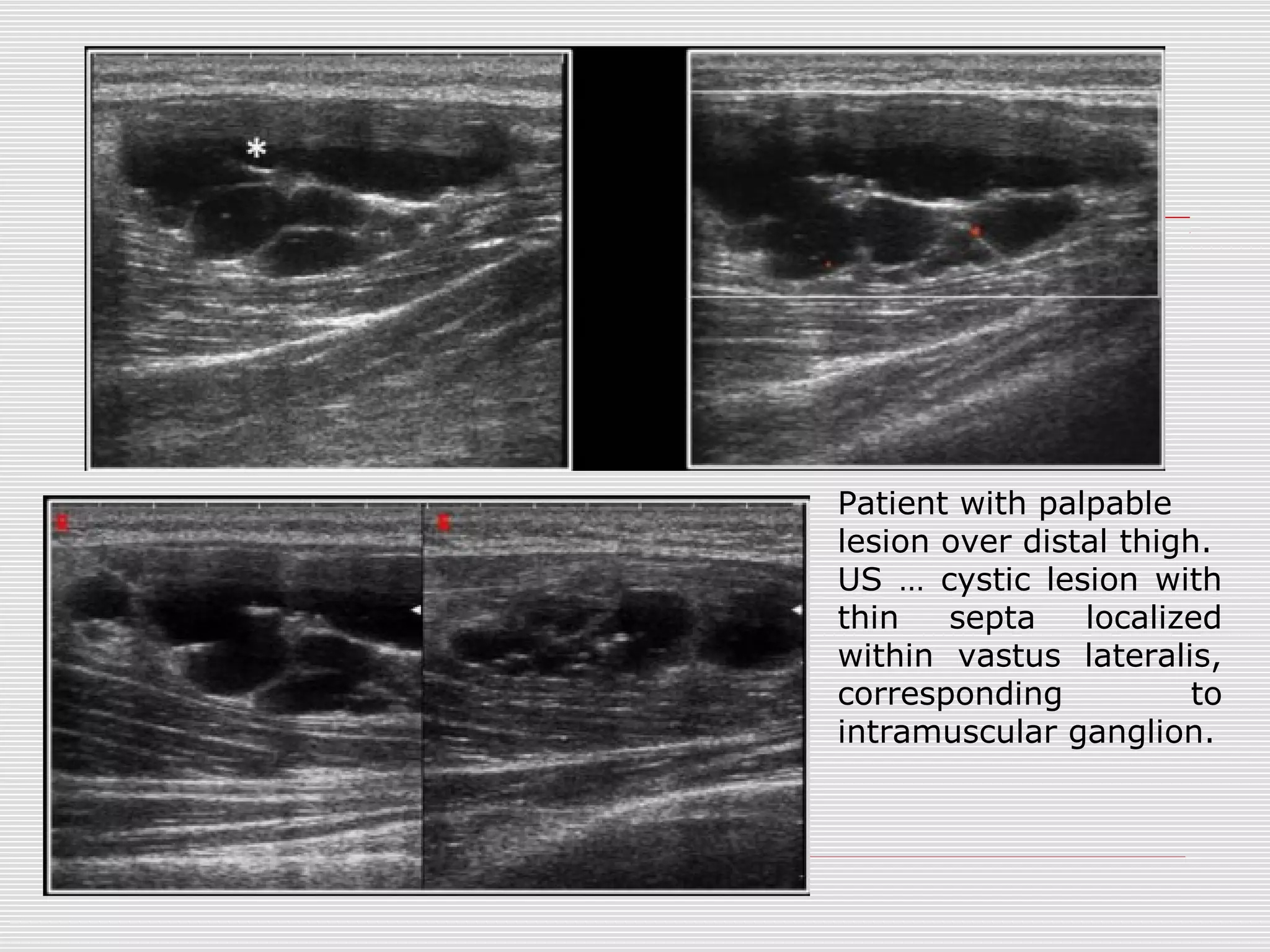 Intra muscular non - traumatic lesions - ultrasonographic evaluation | PPT