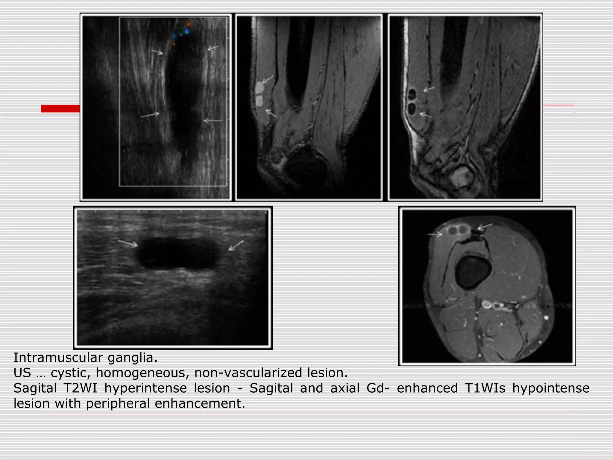 Intra muscular non - traumatic lesions - ultrasonographic evaluation | PPT