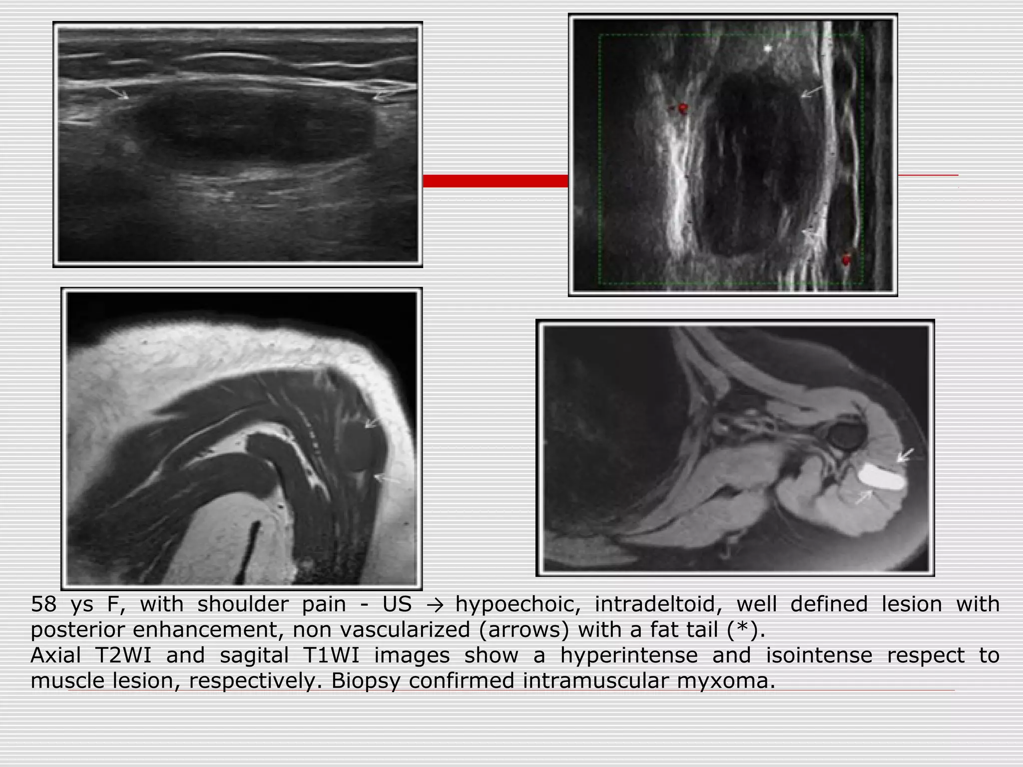 Intra muscular non - traumatic lesions - ultrasonographic evaluation | PPT