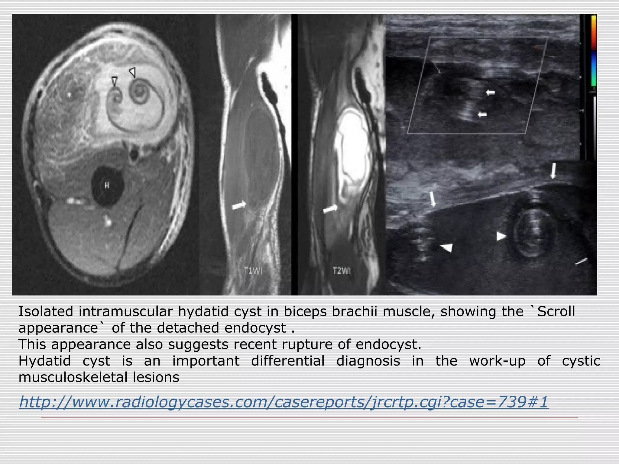 Intra muscular non - traumatic lesions - ultrasonographic evaluation | PPT