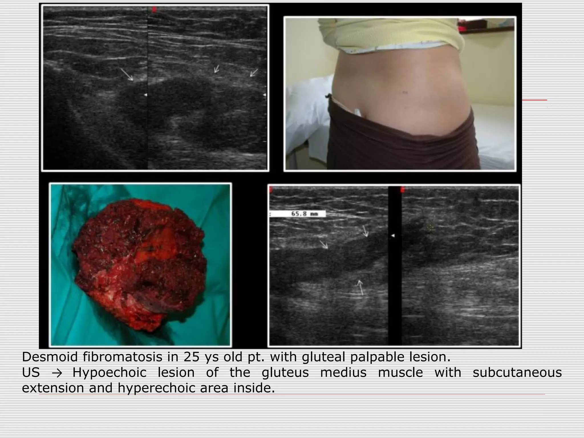 Intra muscular non - traumatic lesions - ultrasonographic evaluation | PPT