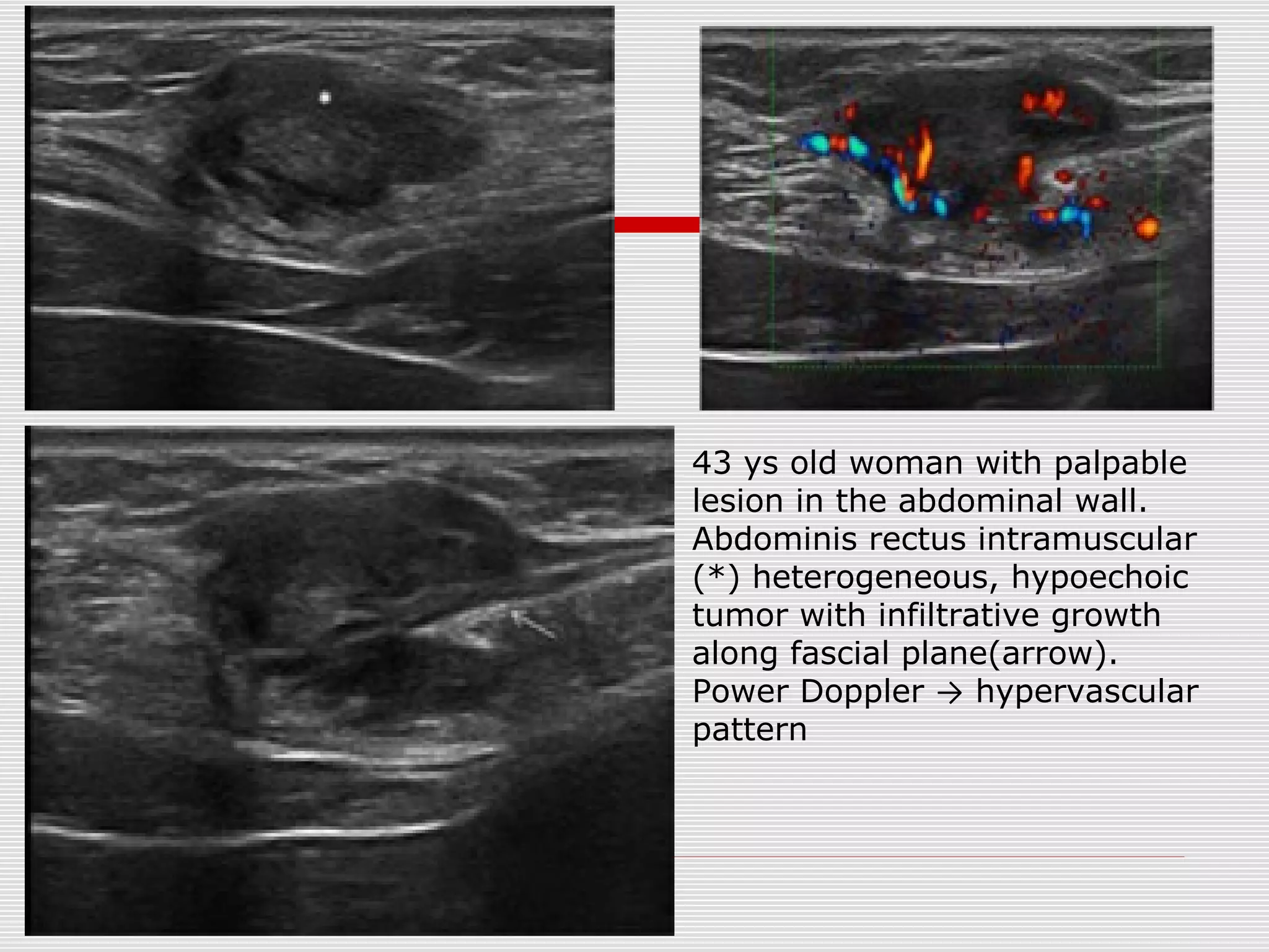 Intra muscular non - traumatic lesions - ultrasonographic evaluation | PPT