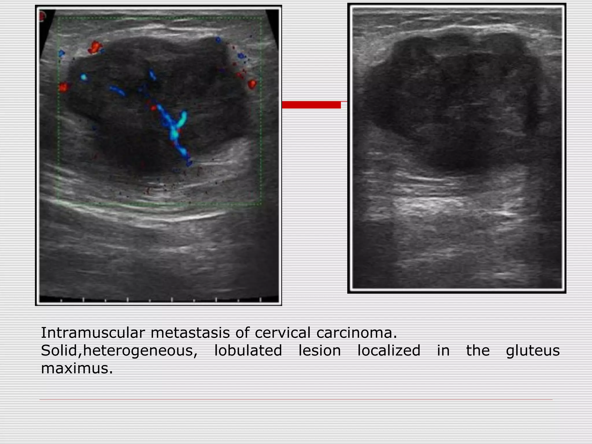 Intra muscular non - traumatic lesions - ultrasonographic evaluation | PPT