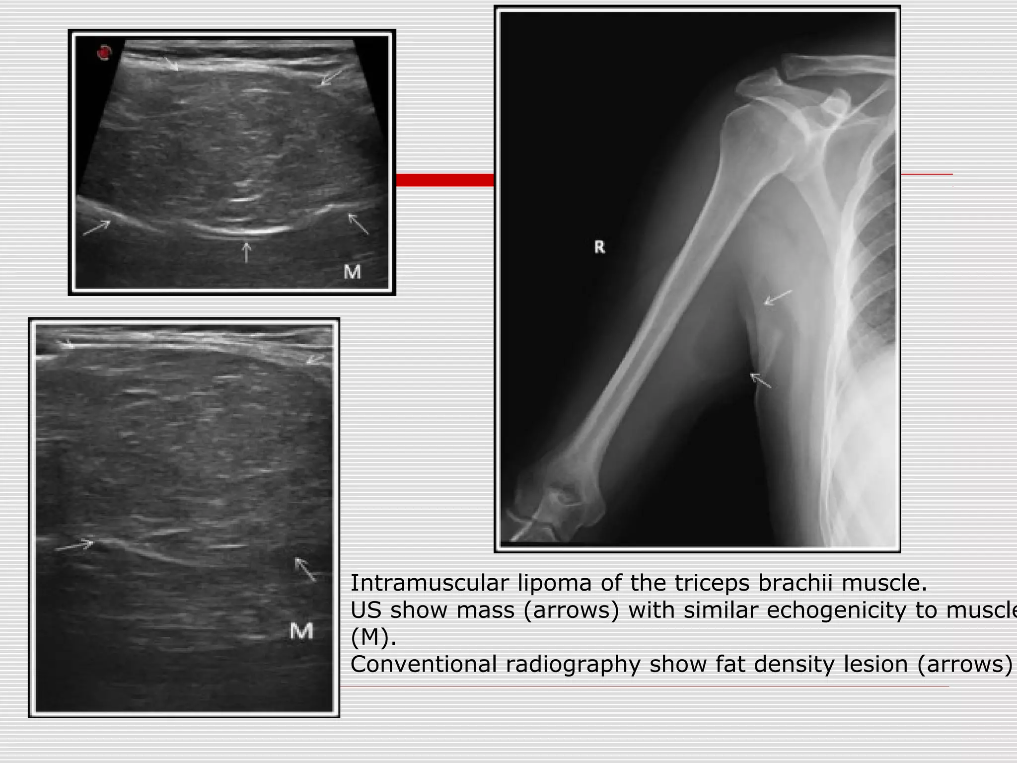Intra muscular non - traumatic lesions - ultrasonographic evaluation | PPT