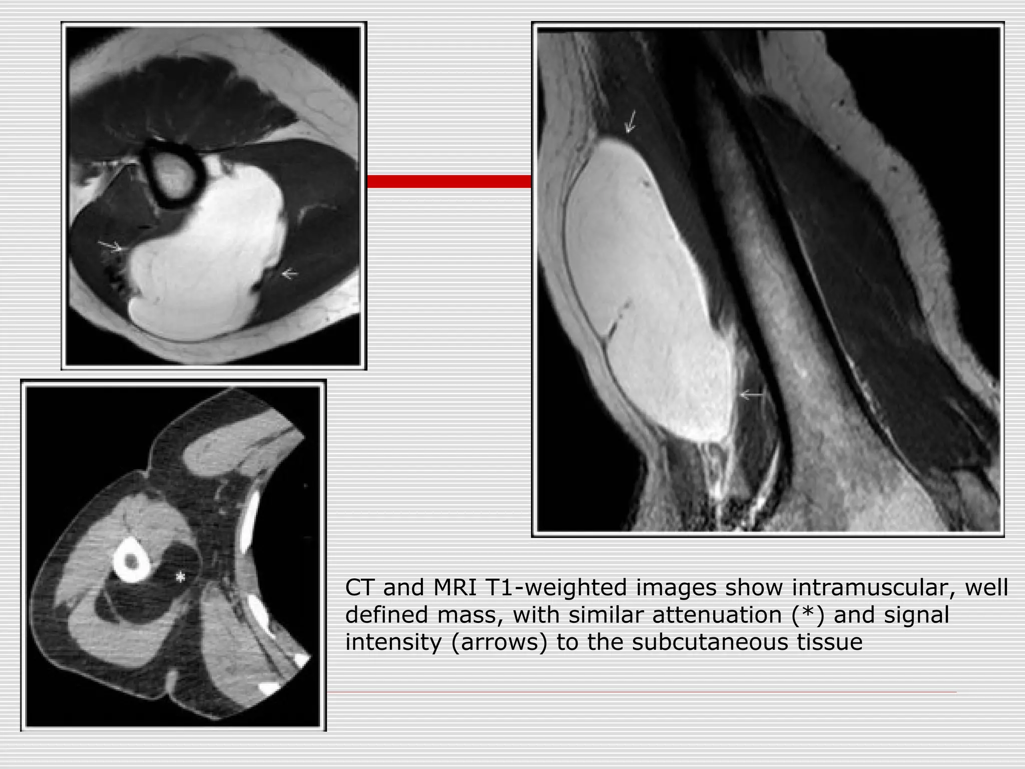 Intra muscular non - traumatic lesions - ultrasonographic evaluation | PPT