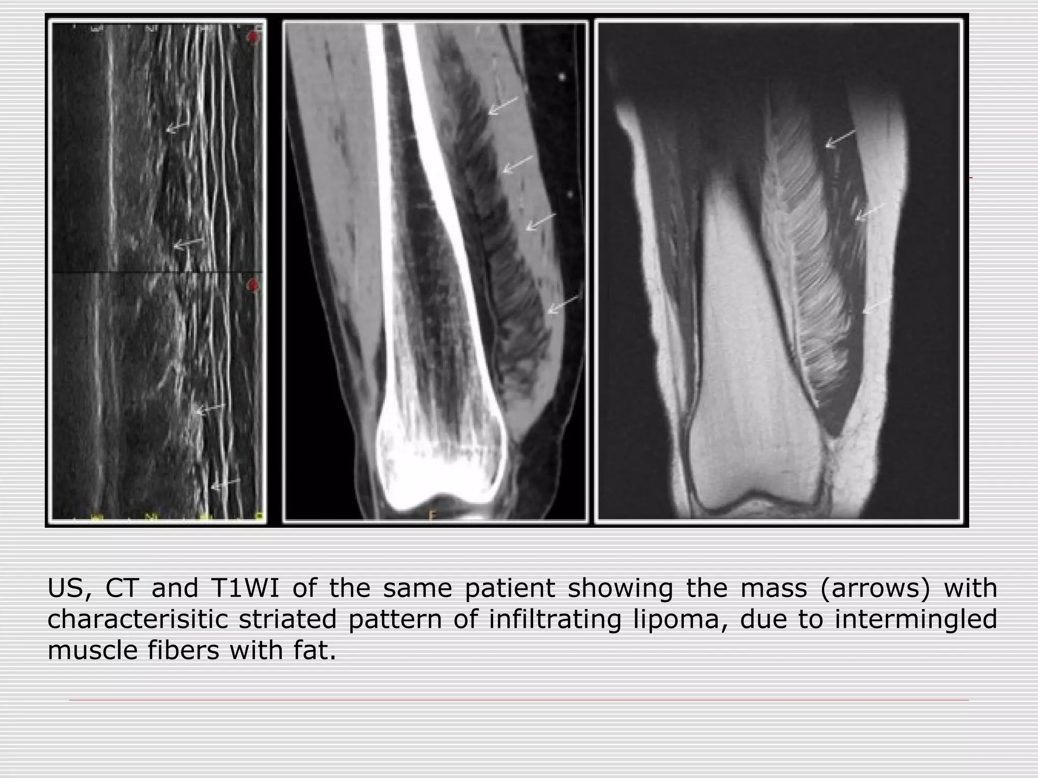 Intra muscular non - traumatic lesions - ultrasonographic evaluation | PPT