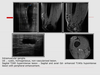 Intra muscular non - traumatic lesions - ultrasonographic evaluation | PPT