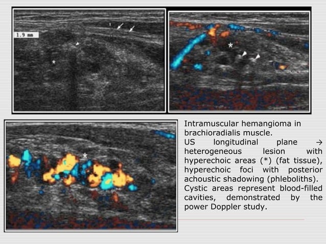 Intra muscular non - traumatic lesions - ultrasonographic evaluation | PPT