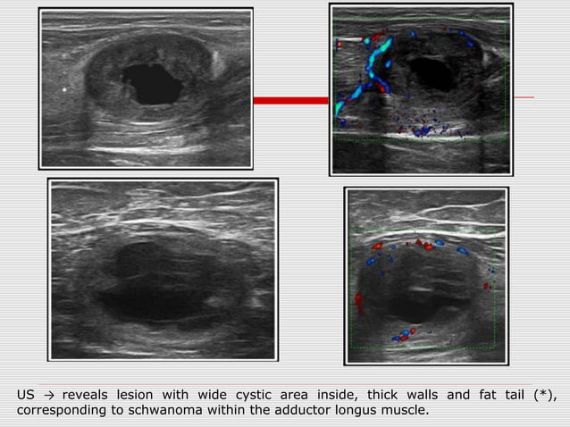 Intra muscular non - traumatic lesions - ultrasonographic evaluation | PPT