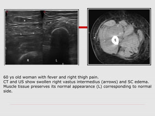 Intra muscular non - traumatic lesions - ultrasonographic evaluation | PPT