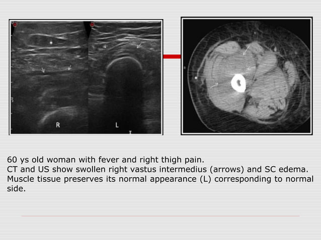 Intra muscular non - traumatic lesions - ultrasonographic evaluation | PPT