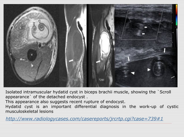 Intra muscular non - traumatic lesions - ultrasonographic evaluation | PPT