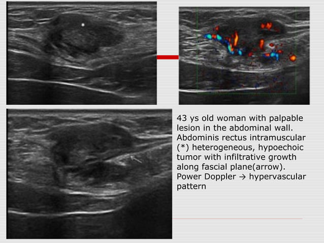 Intra muscular non - traumatic lesions - ultrasonographic evaluation | PPT