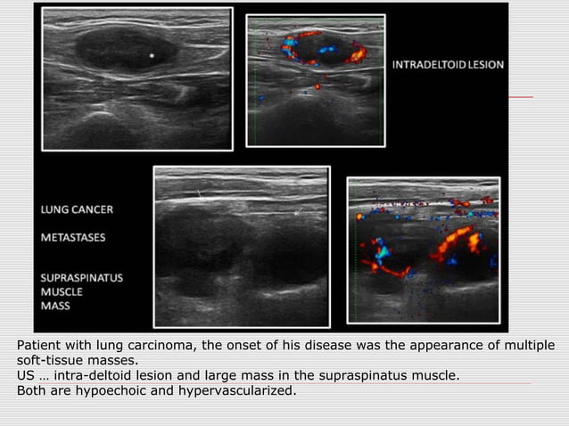 Intra muscular non - traumatic lesions - ultrasonographic evaluation | PPT