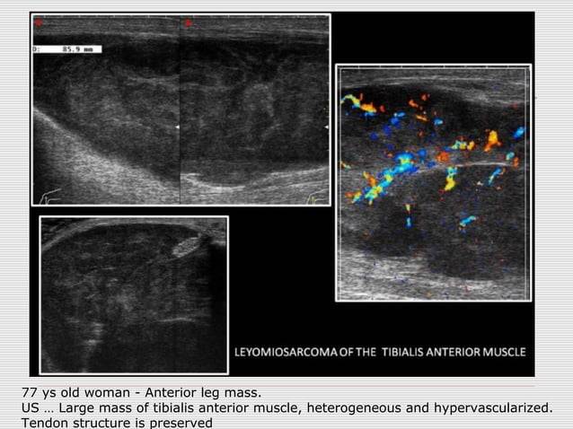Intra muscular non - traumatic lesions - ultrasonographic evaluation | PPT