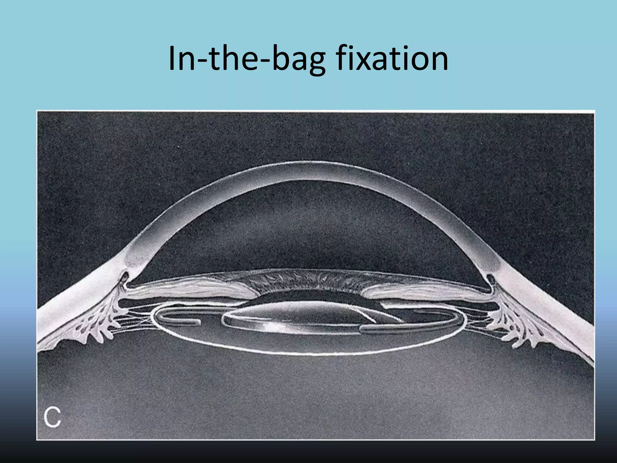 Intra ocular lens | PPTX