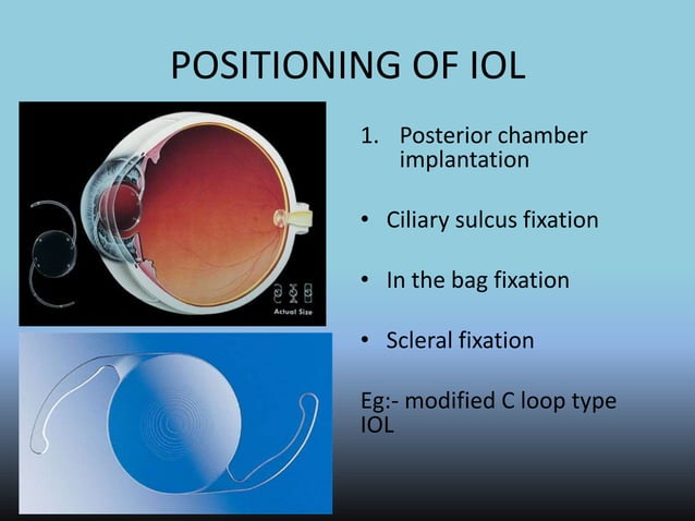 Intra ocular lens | PPTX