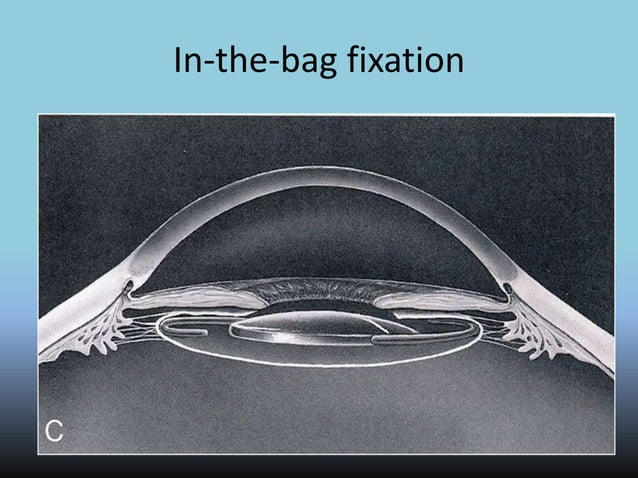 Intra ocular lens | PPTX