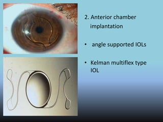 Intra ocular lens | PPTX