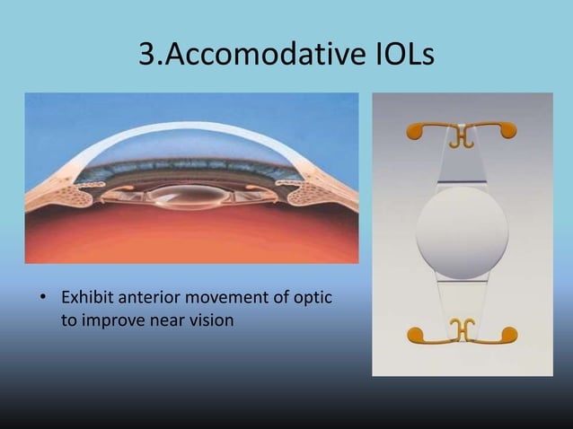 Intra ocular lens | PPTX