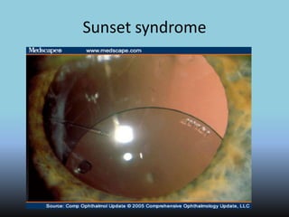 Intra ocular lens | PPT