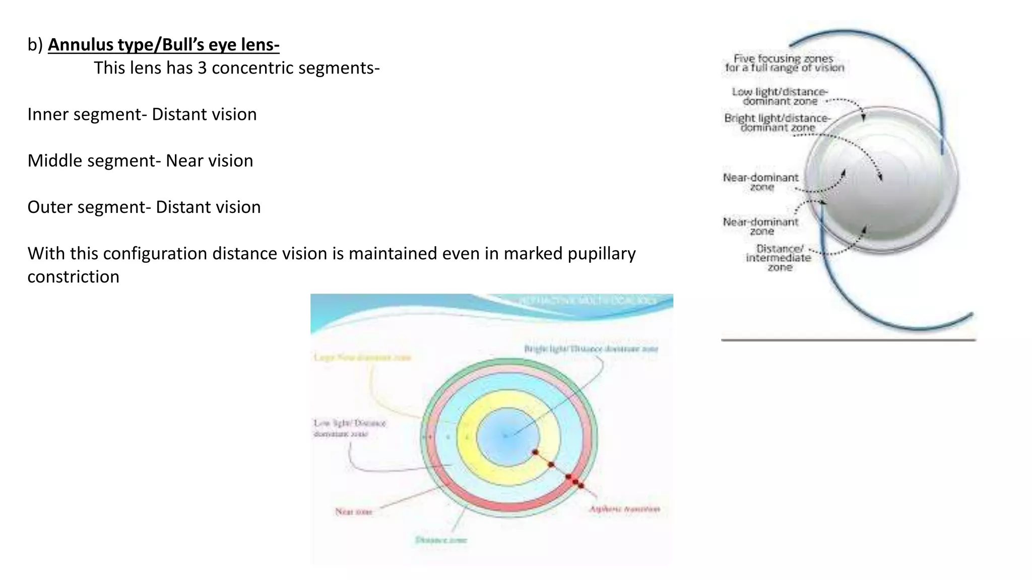 Intra Ocular lens | PPTX