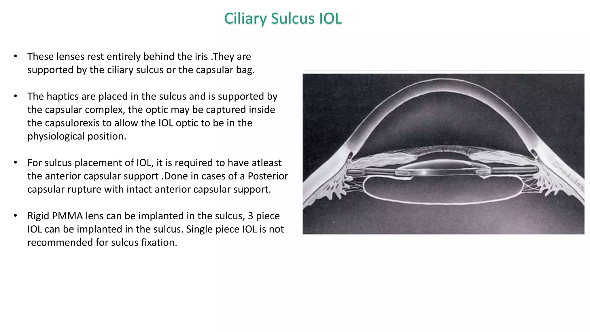 Intra Ocular lens | PPTX