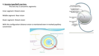Intra Ocular lens | PPTX