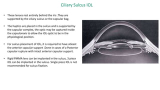 Intra Ocular lens | PPTX