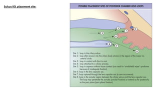 Intra Ocular lens | PPTX