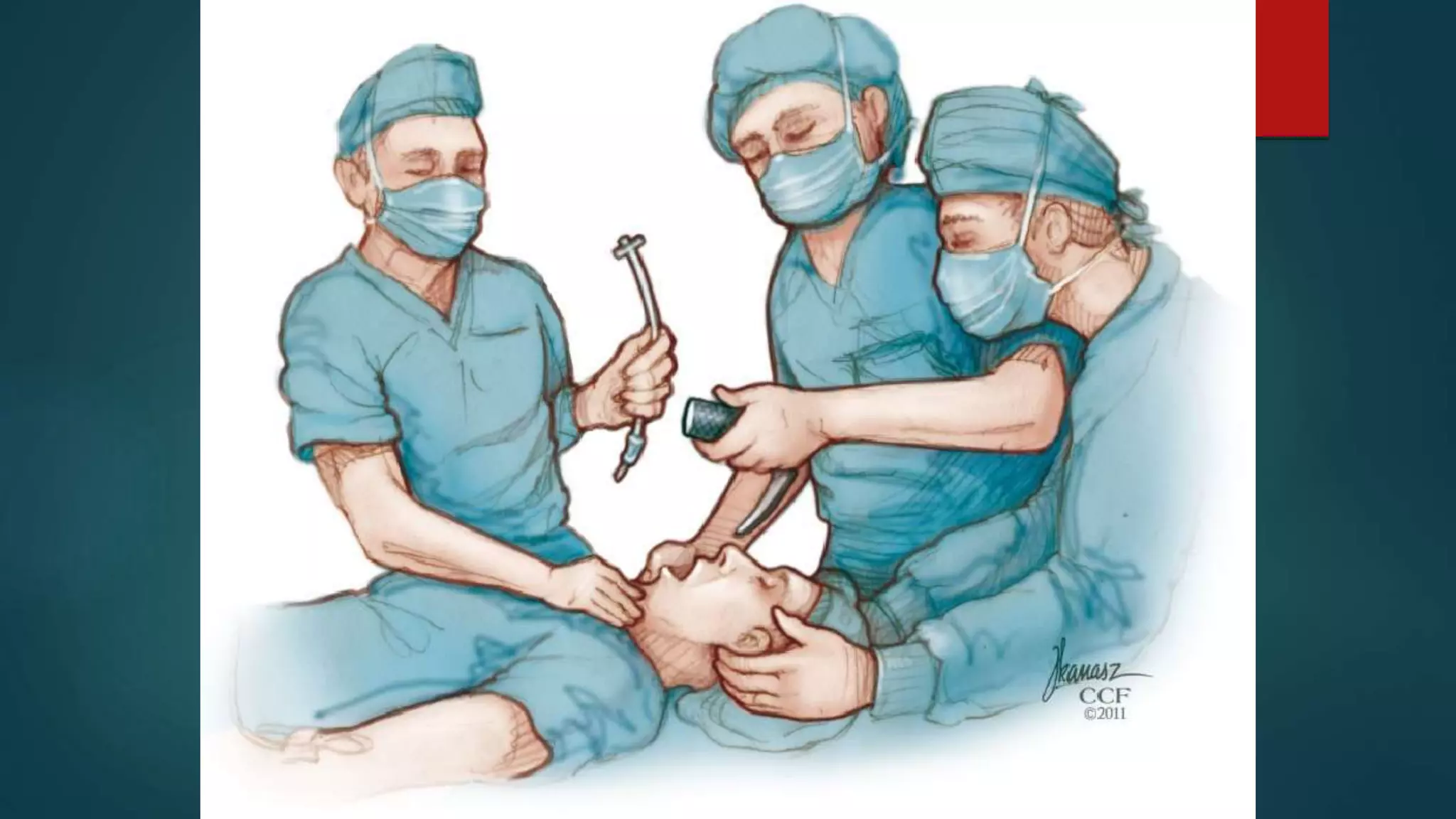 Intra operative cardiac arrest | PPTX