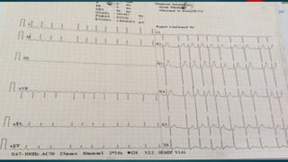 Intra operative cardiac arrest | PPTX