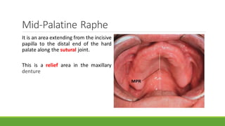 Intra-oral Anatomical Landmarks Related to Removable Prostheses.pdf