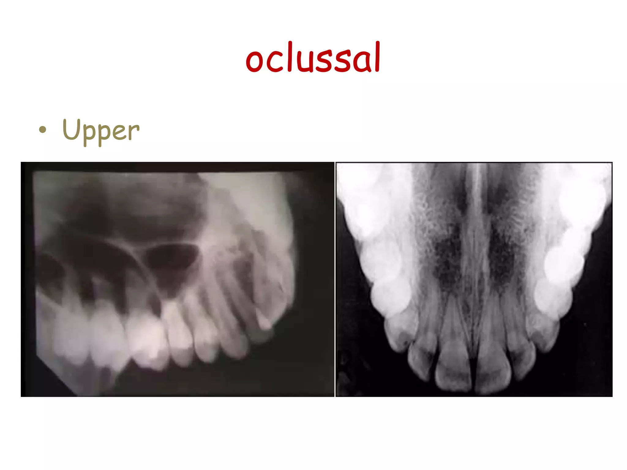 Intra oral radiograph techniques | PPTX