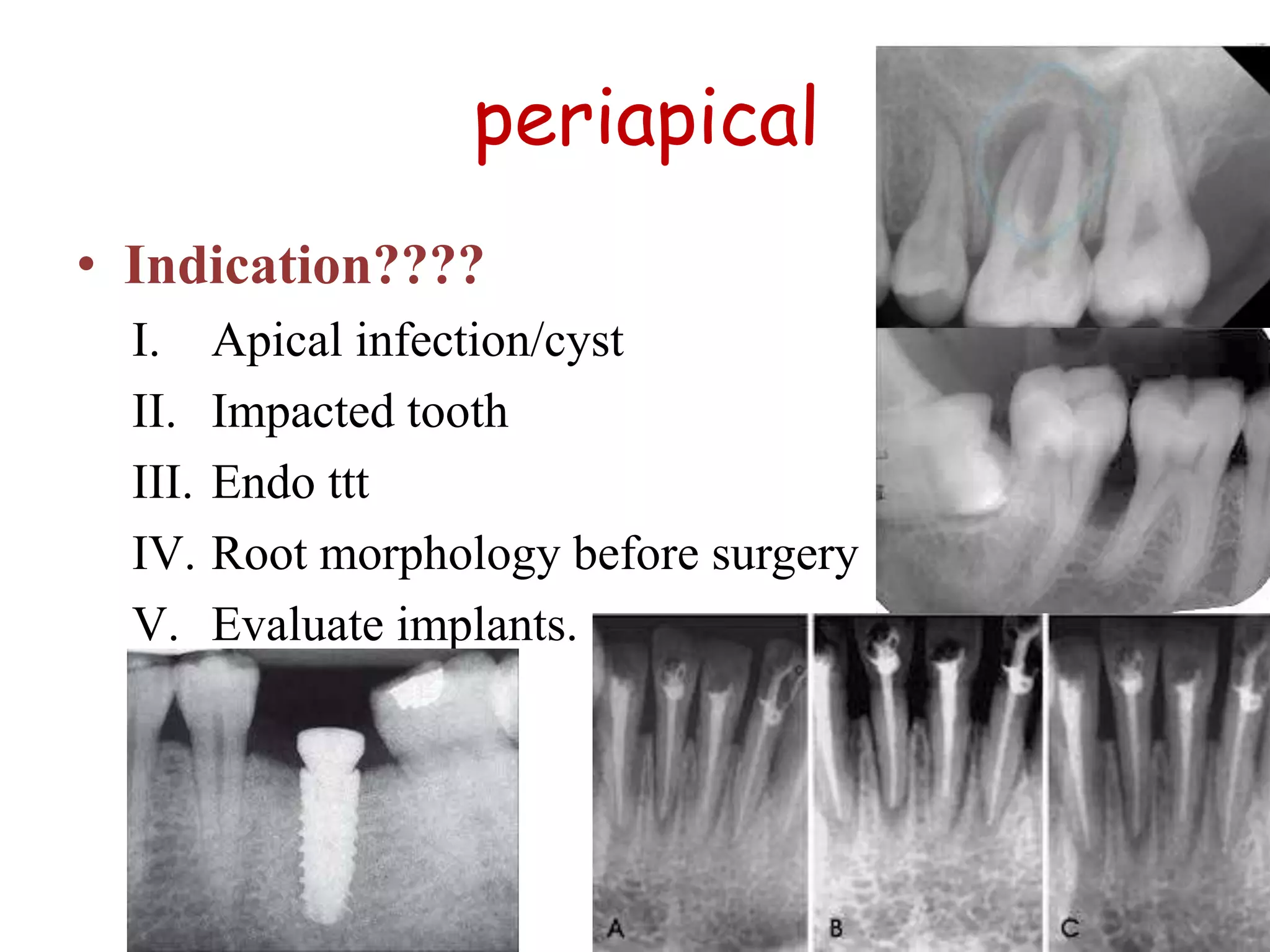 Intra oral radiograph techniques | PPTX