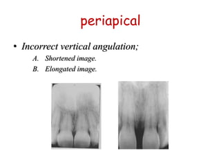 Intra oral radiograph techniques | PPTX