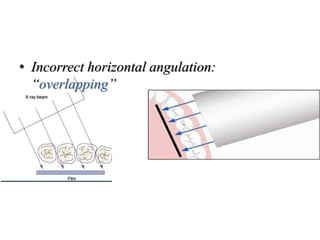 Intra oral radiograph techniques | PPTX