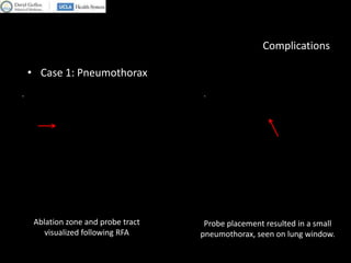 Intra procedural ct during rfa final | PPT