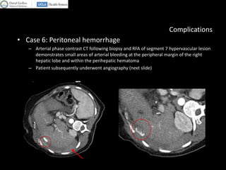 Intra procedural ct during rfa final | PPT