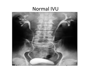 Intra venous urography By Dr Sahar Zubair | PPT