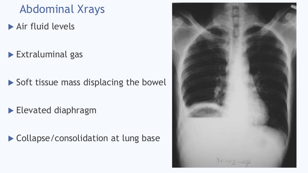 Intra abdominal abscess
