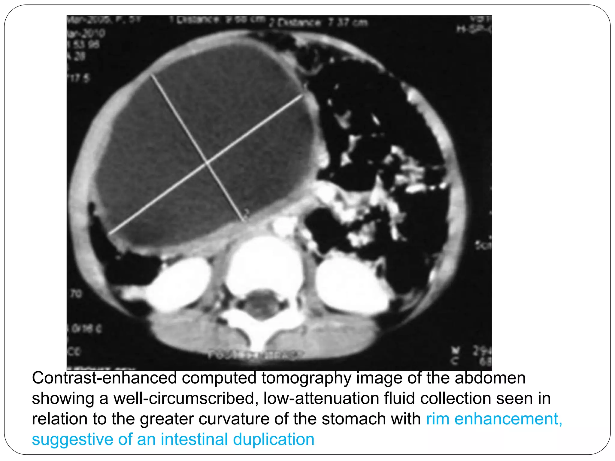 Intra abdominal cysts in children | PPTX