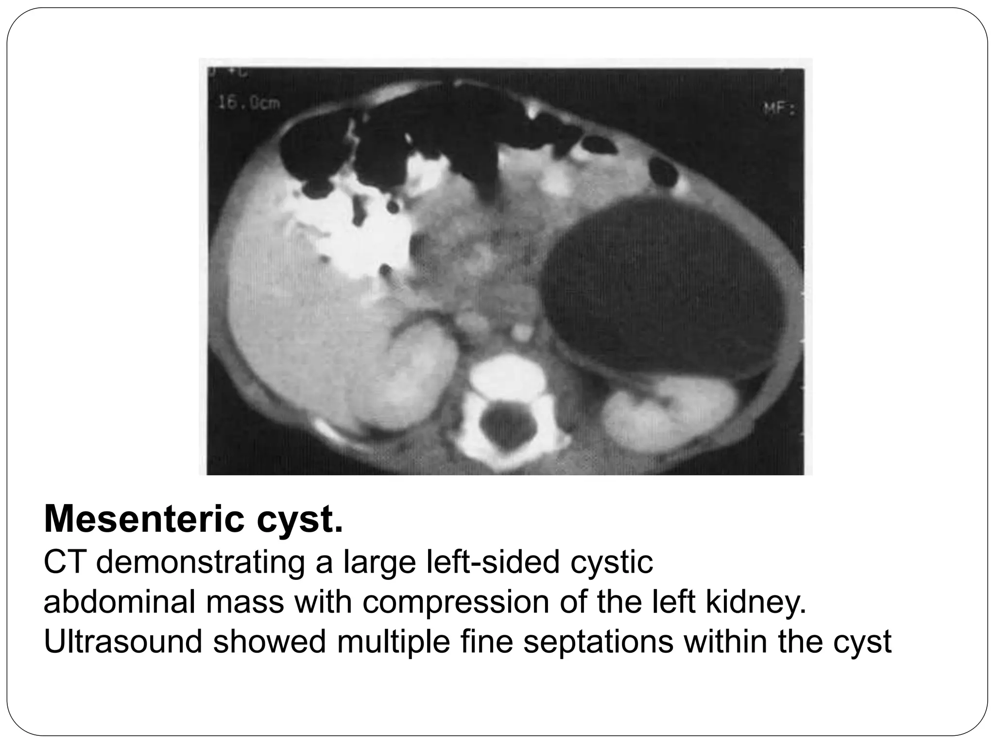 Intra abdominal cysts in children | PPTX