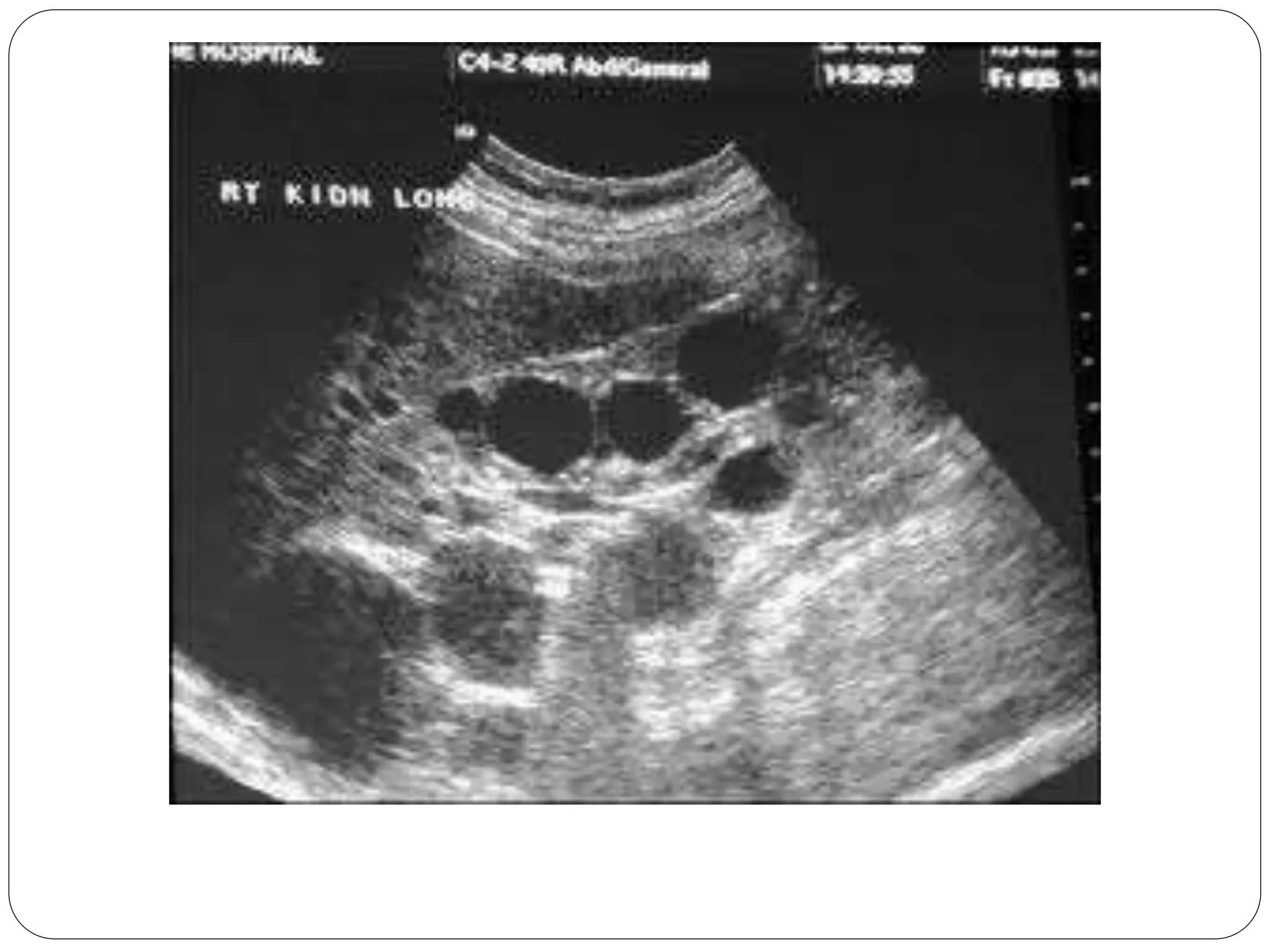 Intra abdominal cysts in children | PPTX