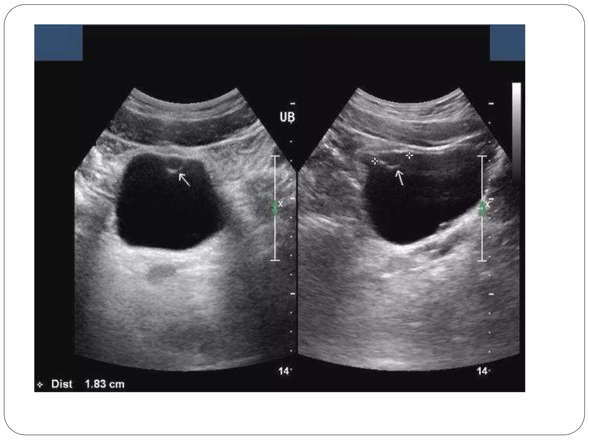 Intra abdominal cysts in children | PPTX