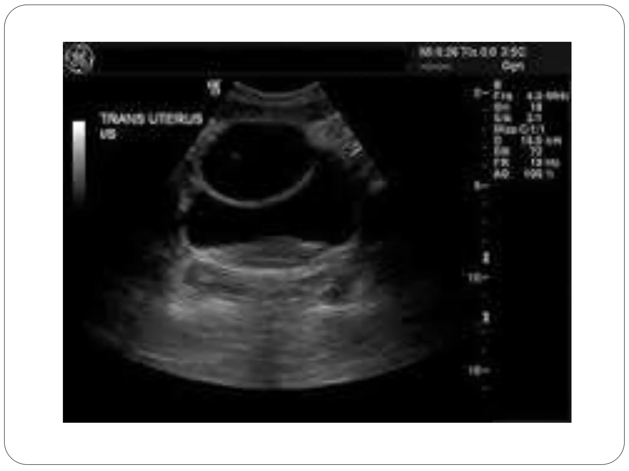 Intra abdominal cysts in children | PPTX