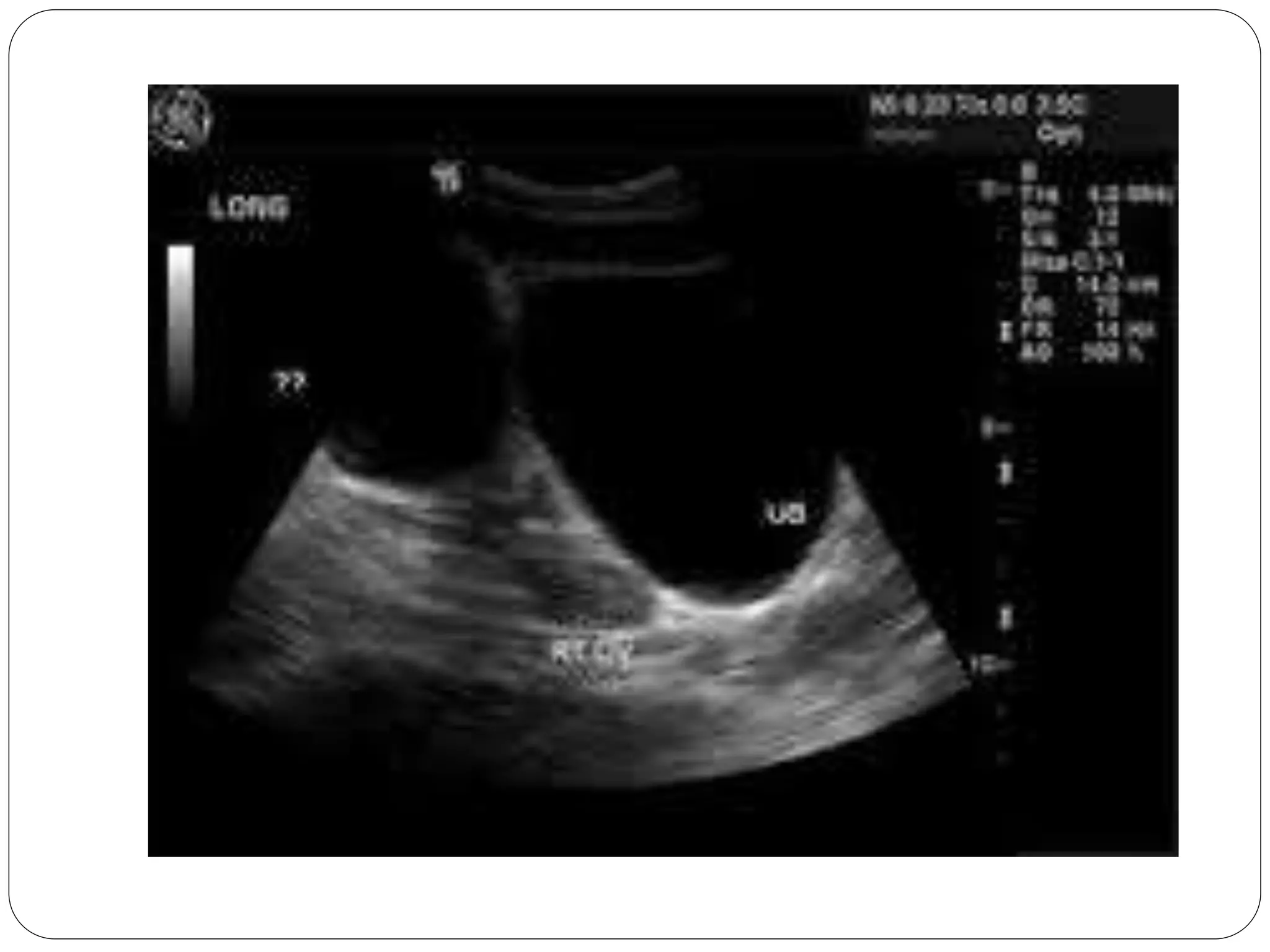 Intra abdominal cysts in children | PPTX